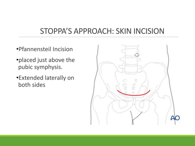 Surgical Approaches to Acetabulum and Pelvis | PPTX