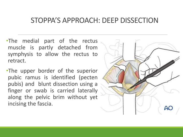 Surgical Approaches to Acetabulum and Pelvis | PPTX