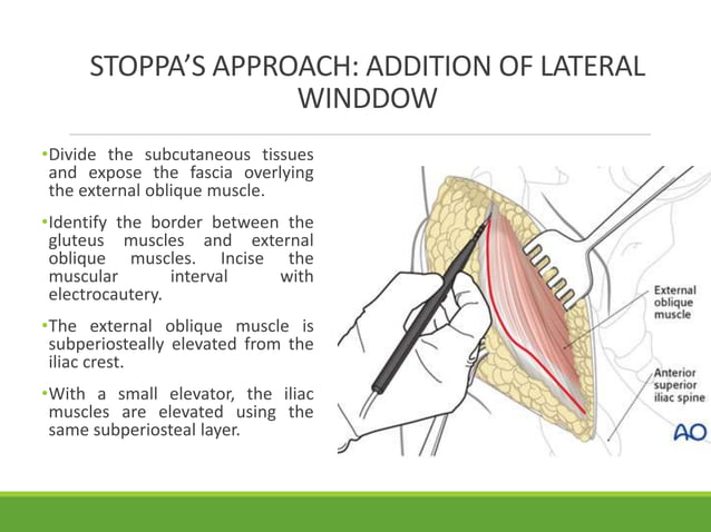 Surgical Approaches to Acetabulum and Pelvis | PPTX