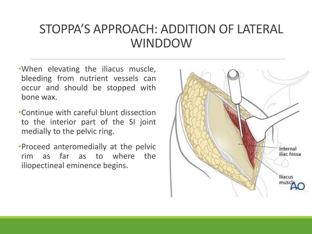 Surgical Approaches to Acetabulum and Pelvis | PPTX