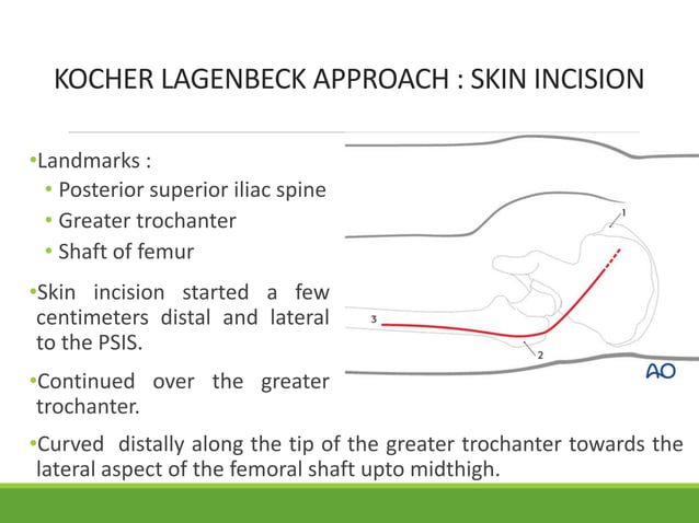 Surgical Approaches to Acetabulum and Pelvis | PPTX