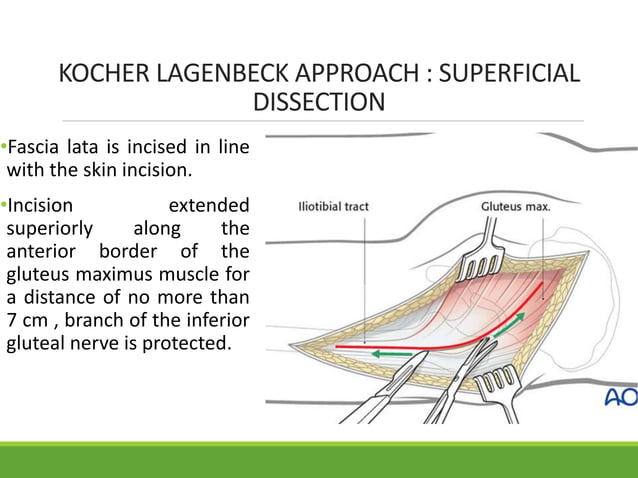 Surgical Approaches to Acetabulum and Pelvis | PPTX