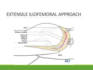 Surgical Approaches to Acetabulum and Pelvis | PPTX