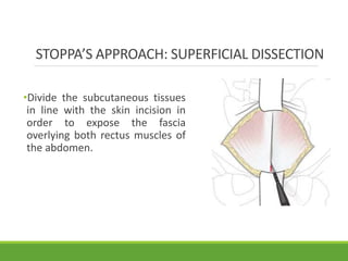 Surgical Approaches to Acetabulum and Pelvis | PPT