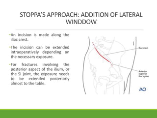 Surgical Approaches to Acetabulum and Pelvis | PPT