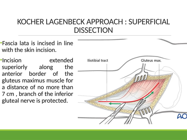 surgical approachto acetabulumand pelvis.pptx