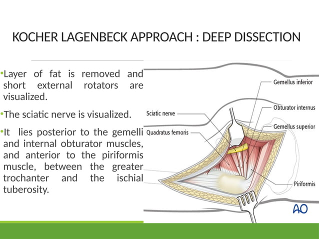 surgical approachto acetabulumand pelvis.pptx