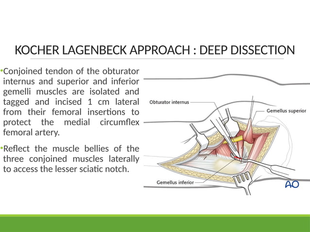 surgical approachto acetabulumand pelvis.pptx