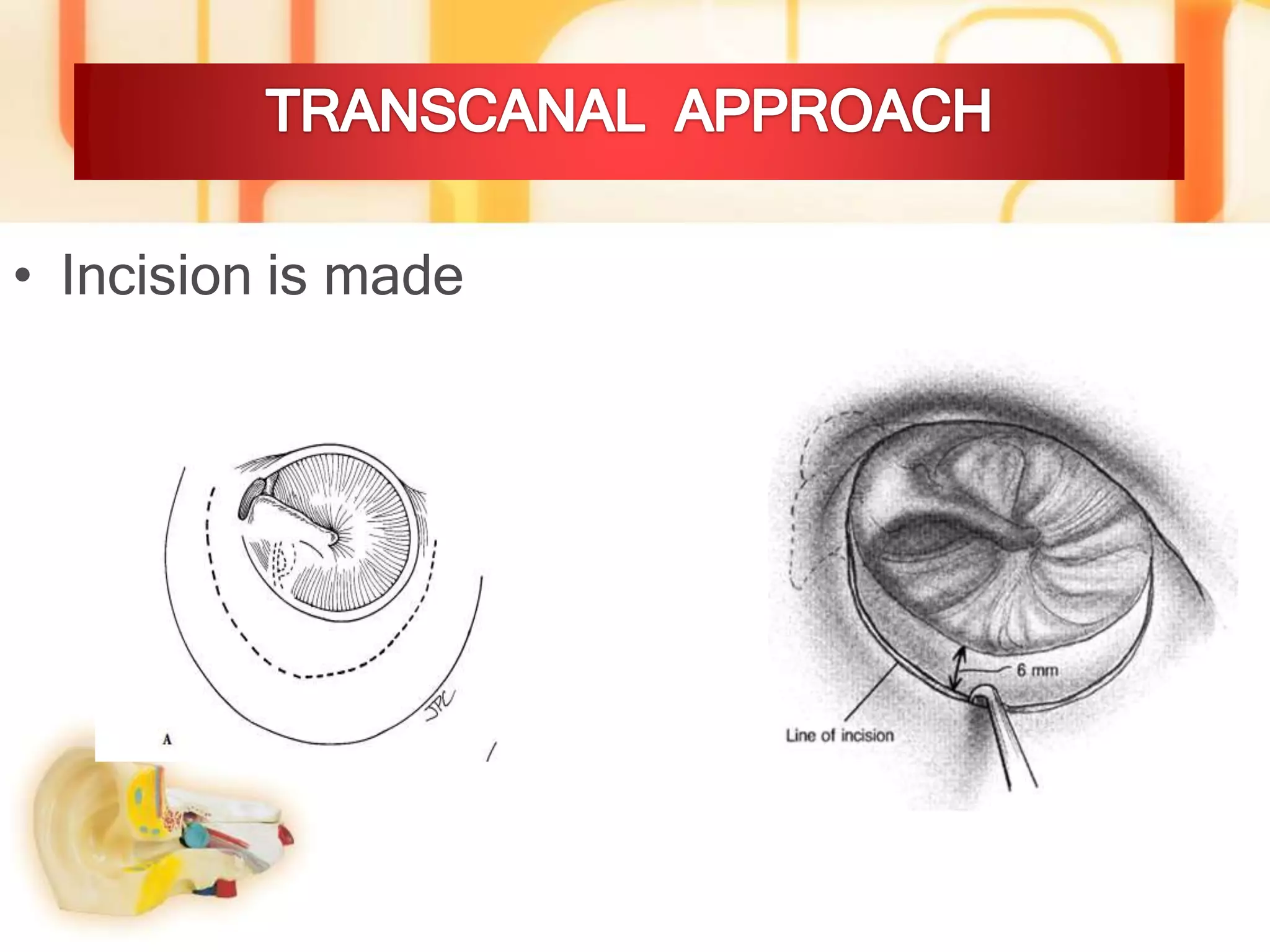 Surgical approach to middle ear,mastoid mamoon | PPTX