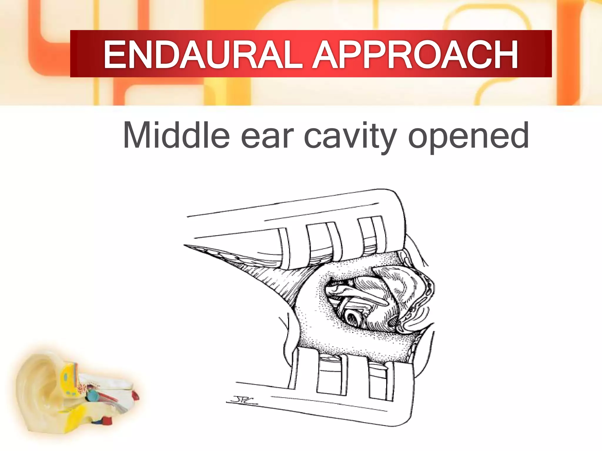 Surgical approach to middle ear,mastoid mamoon | PPTX