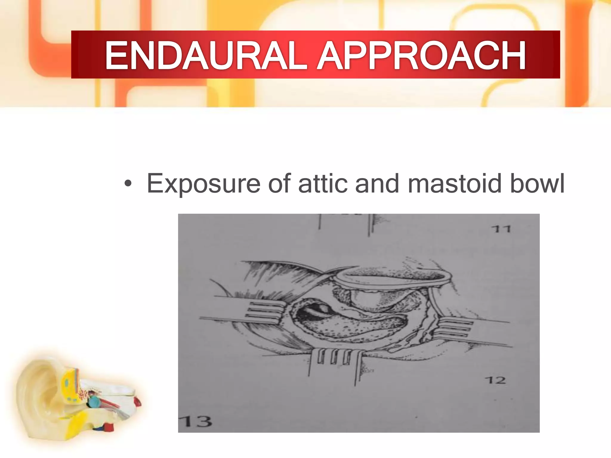 Surgical approach to middle ear,mastoid mamoon | PPTX