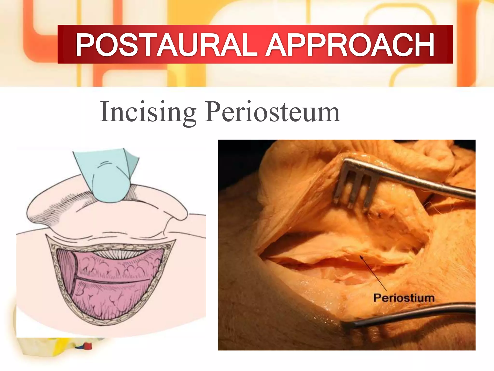 Surgical approach to middle ear,mastoid mamoon | PPTX