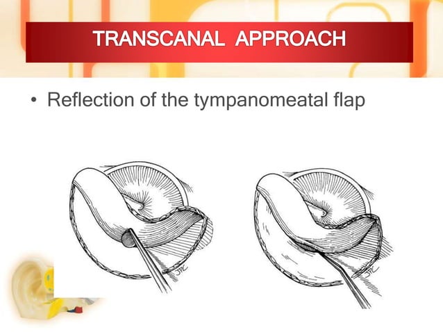 Surgical approach to middle ear,mastoid mamoon | PPTX | Ear, Nose and ...