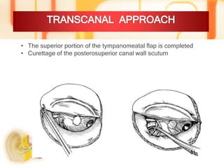 Surgical approach to middle ear,mastoid mamoon | PPTX