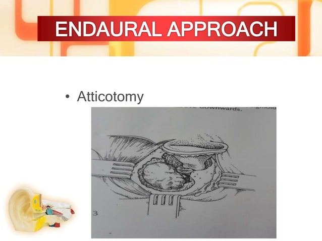 Surgical approach to middle ear,mastoid mamoon | PPTX | Ear, Nose and ...