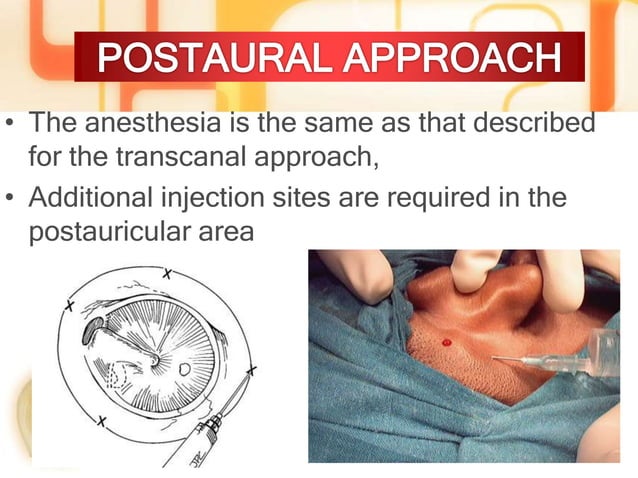 Surgical approach to middle ear,mastoid mamoon | PPTX | Ear, Nose and ...