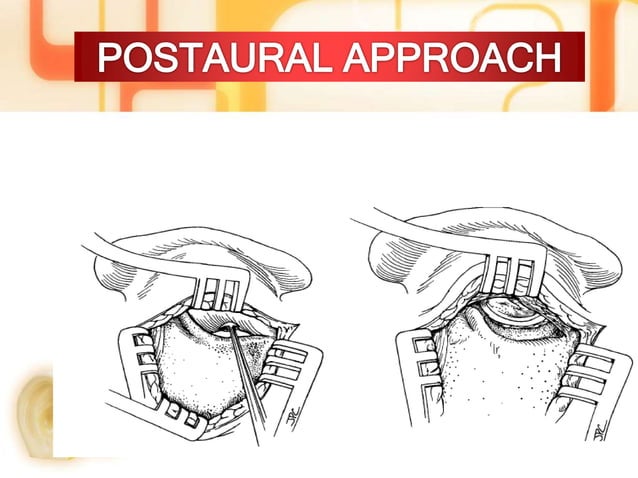 Surgical approach to middle ear,mastoid mamoon | PPTX | Ear, Nose and ...