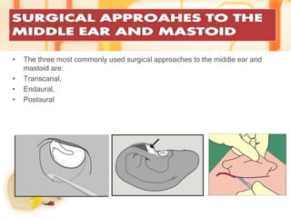 Mastoidectomy Incision