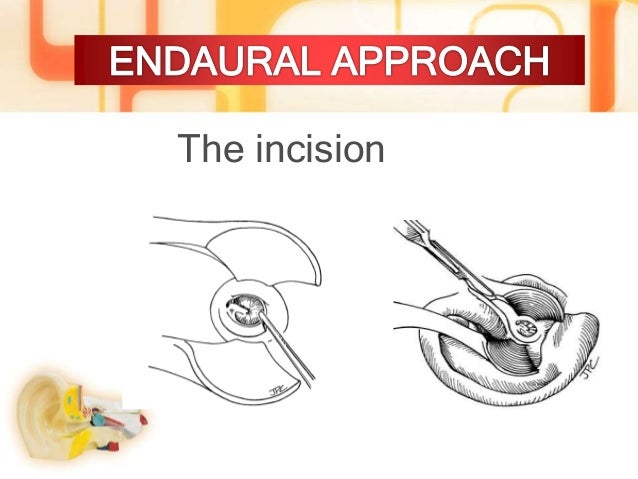 Surgical approach to middle ear,mastoid mamoon