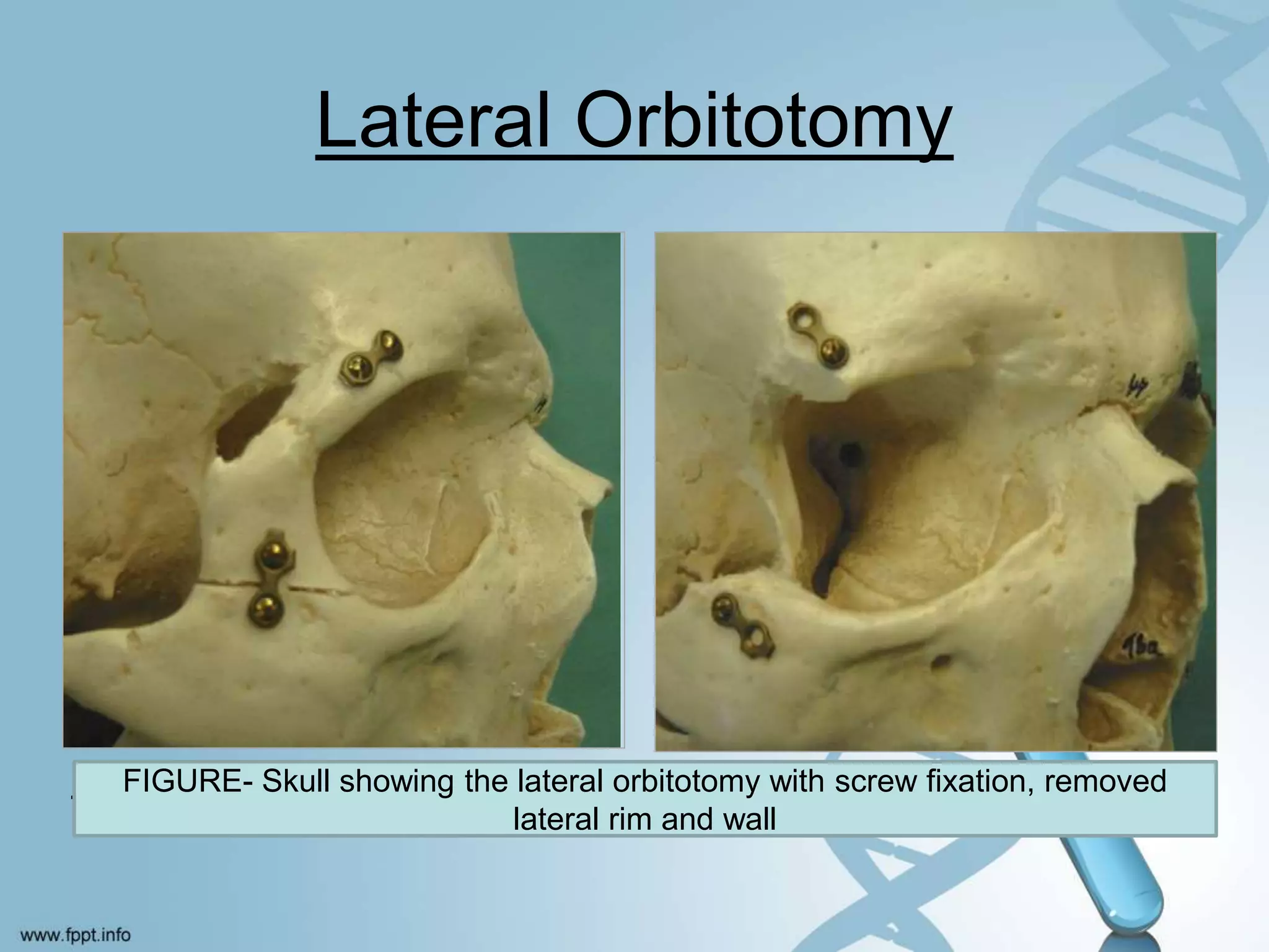 Surgical approach to orbital tumour | PPTX
