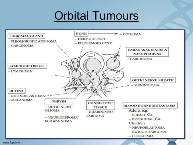 Surgical approach to orbital tumour | PPTX | Eye and Vision Conditions ...