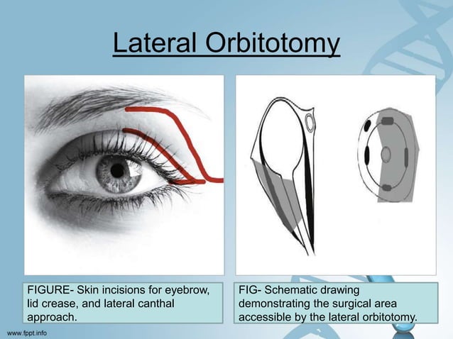 Surgical approach to orbital tumour