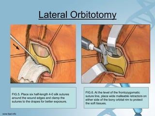 Surgical approach to orbital tumour | PPT