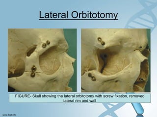 Surgical approach to orbital tumour | PPT