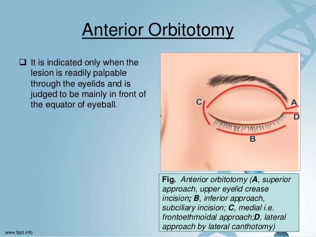 Surgical approach to orbital tumour