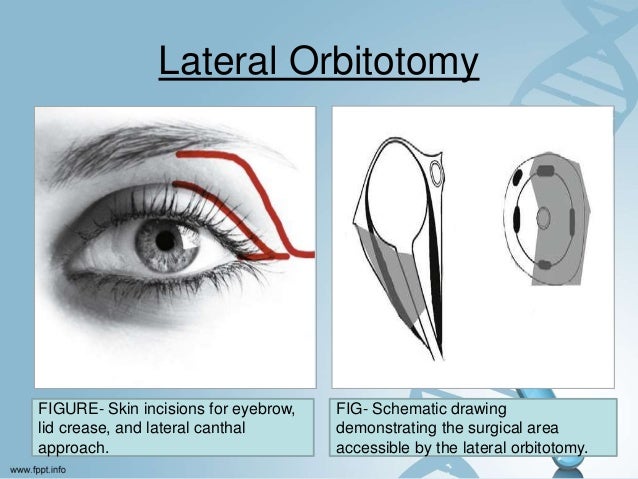Surgical approach to orbital tumour
