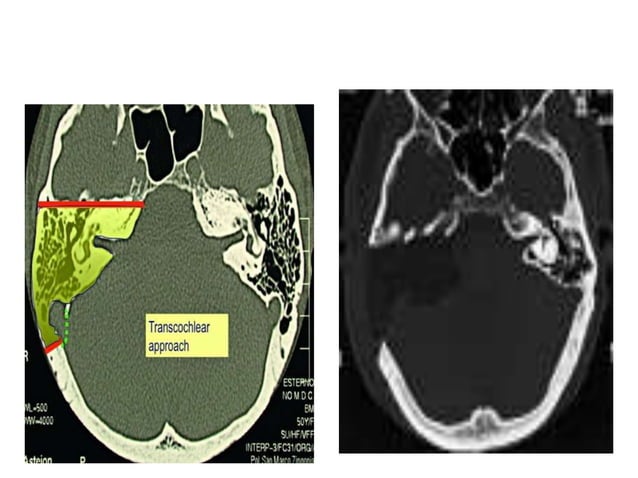 Surgical approaches to skull base | PPTX | Death, Injury, or Military ...