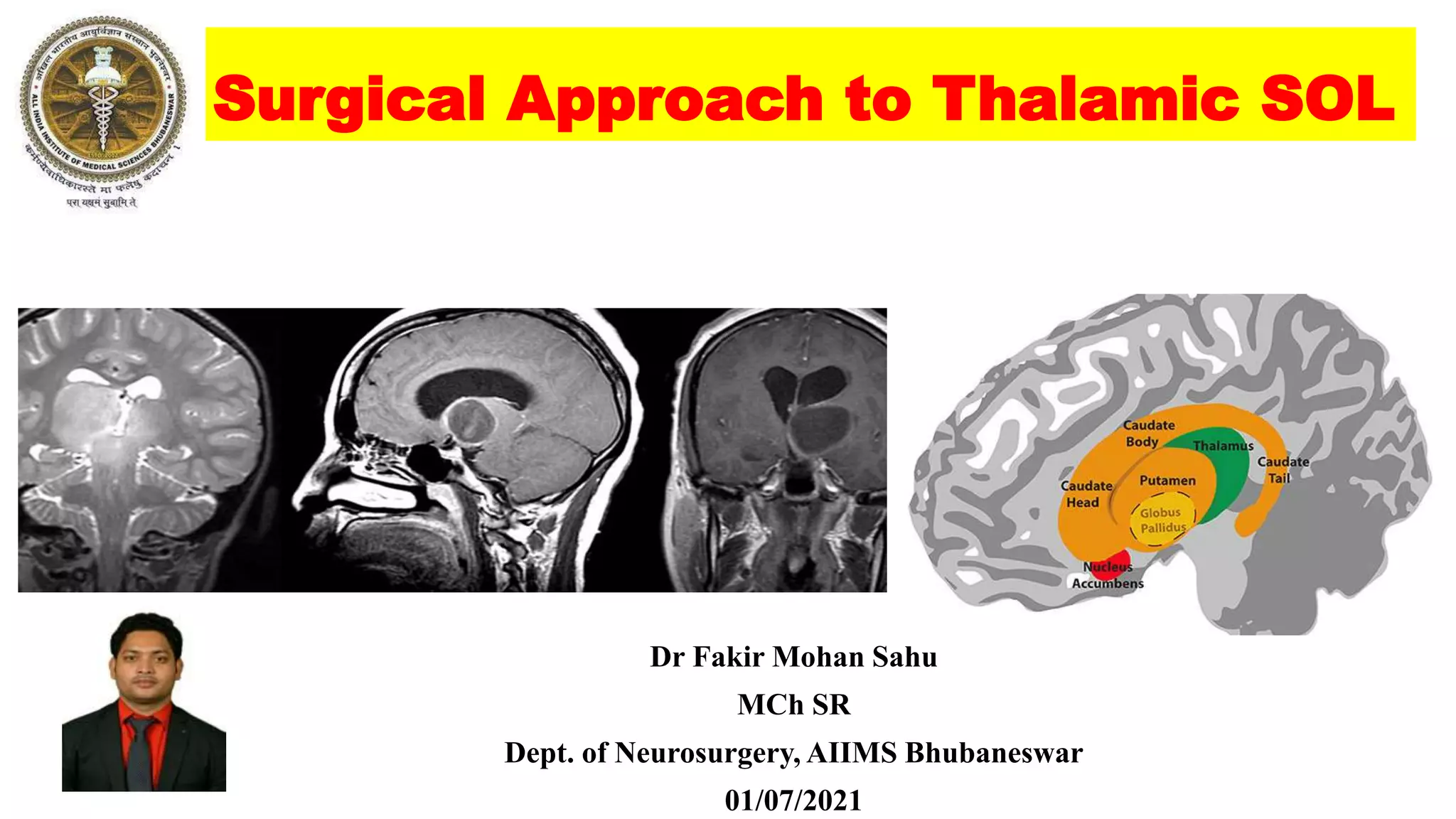 Surgical approach to thalamus | PPTX