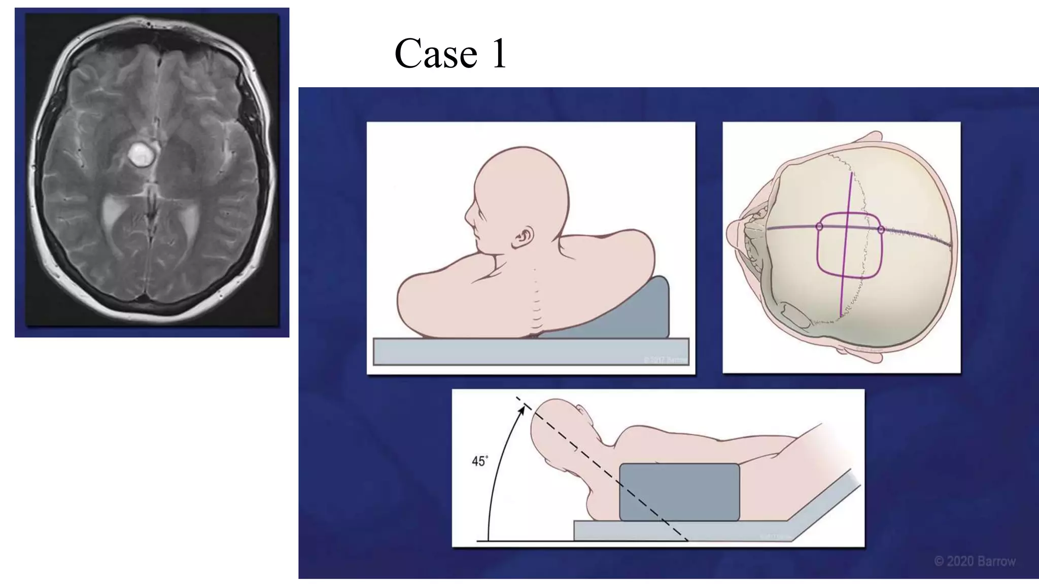 Surgical approach to thalamus | PPTX
