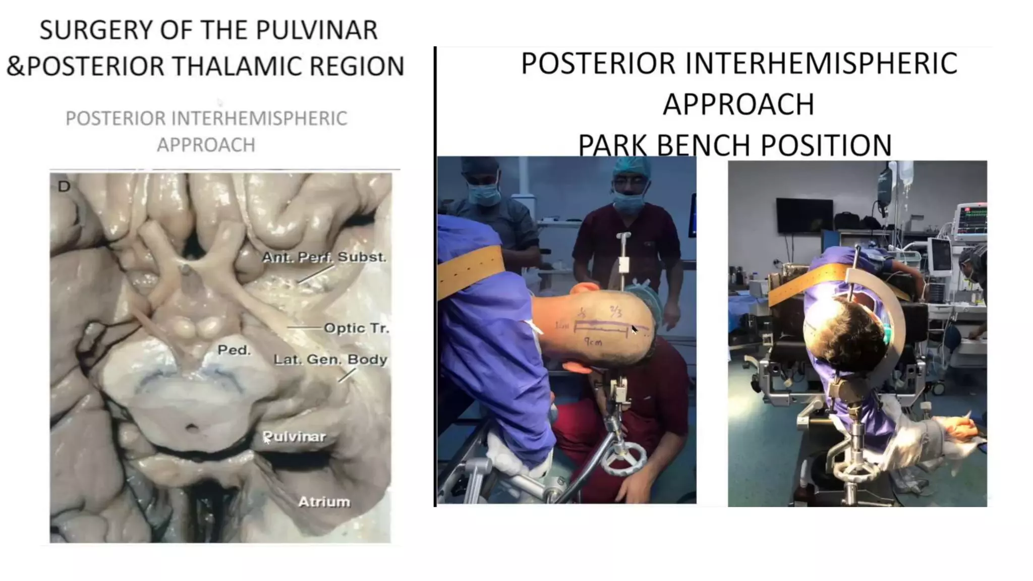 Surgical approach to thalamus | PPTX