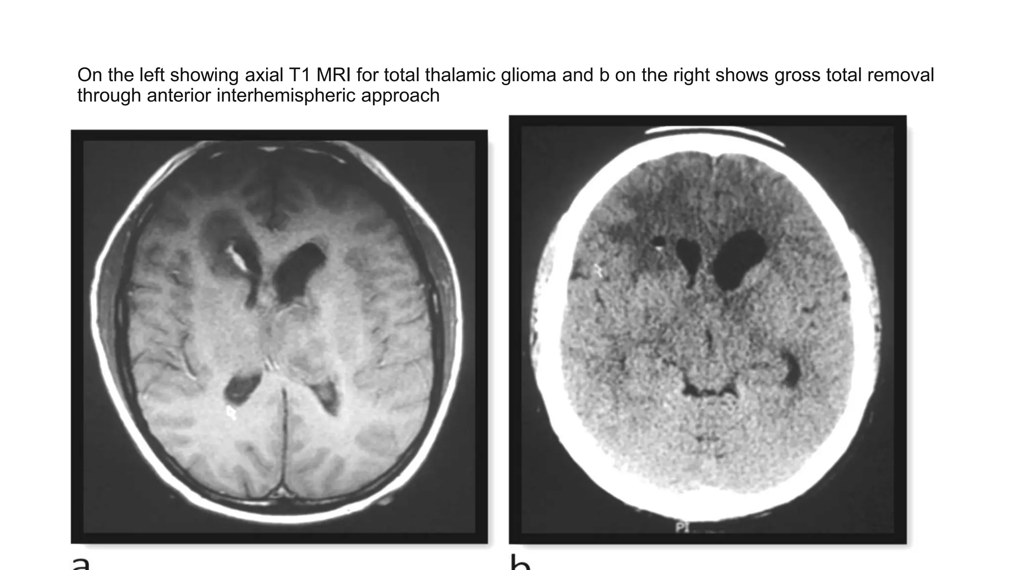 Surgical approach to thalamus | PPTX