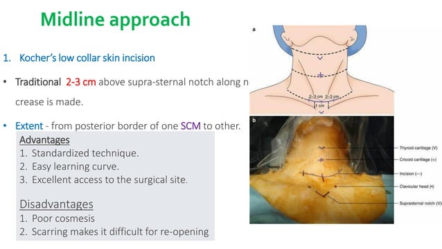 Surgical approach to thyroid and post operative care | PDF