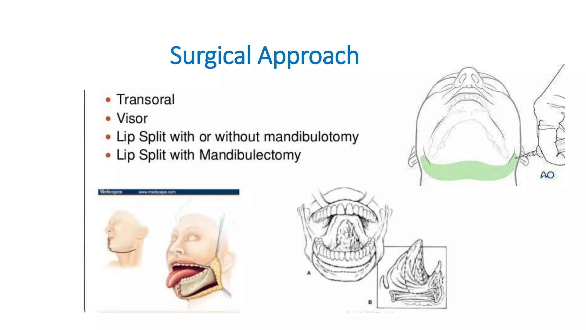 Surgical approach in oral cavity | PPTX