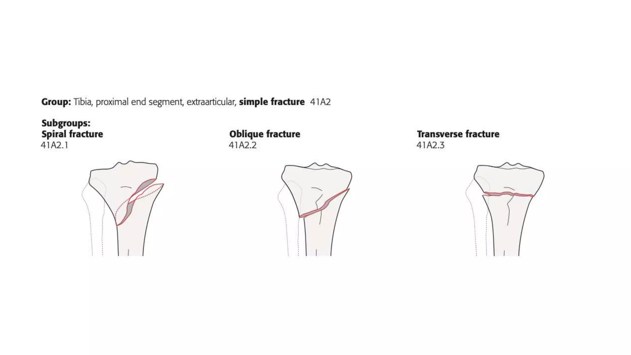 Surgical approaches tibia fibula | PPTX