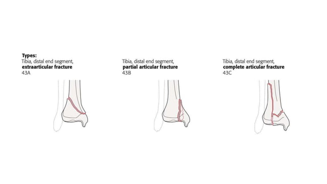 Surgical approaches tibia fibula | PPTX