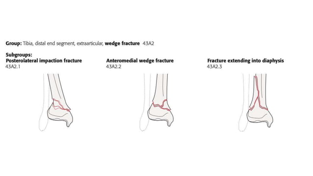 Surgical approaches tibia fibula | PPTX