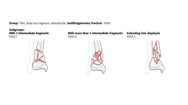 Surgical approaches tibia fibula | PPTX