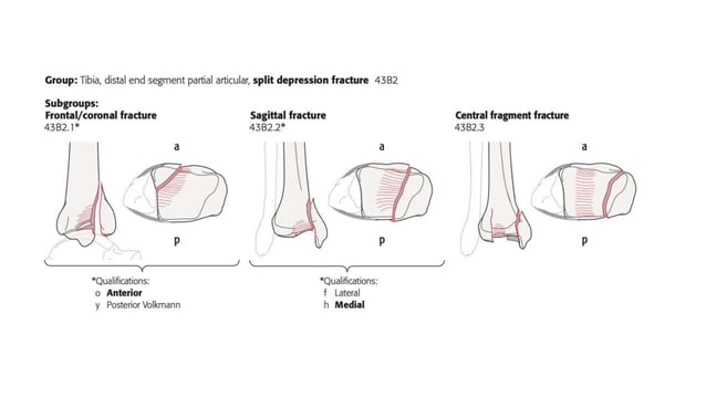 Surgical approaches tibia fibula | PPTX