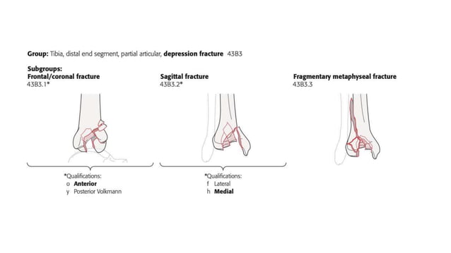 Surgical approaches tibia fibula | PPTX