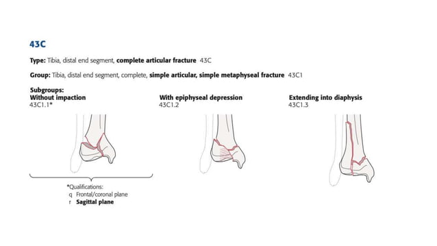 Surgical approaches tibia fibula | PPTX