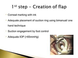 Surgical Aspect of Lasik | PPT