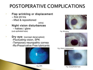 Surgical Aspect of Lasik | PPT