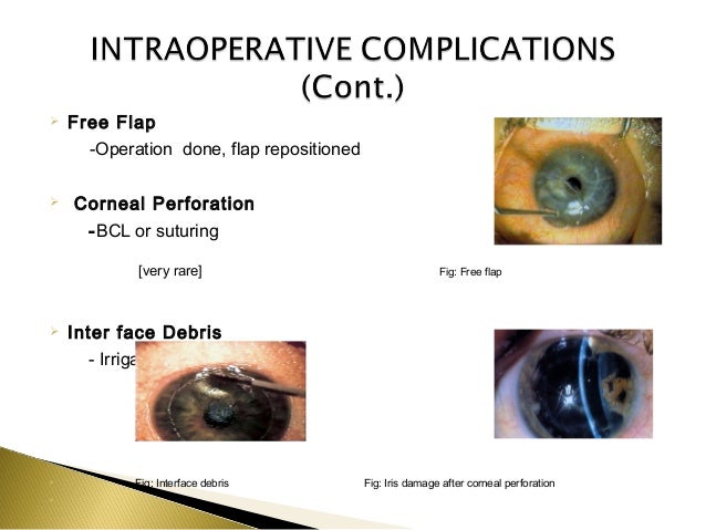 Surgical Aspect of Lasik