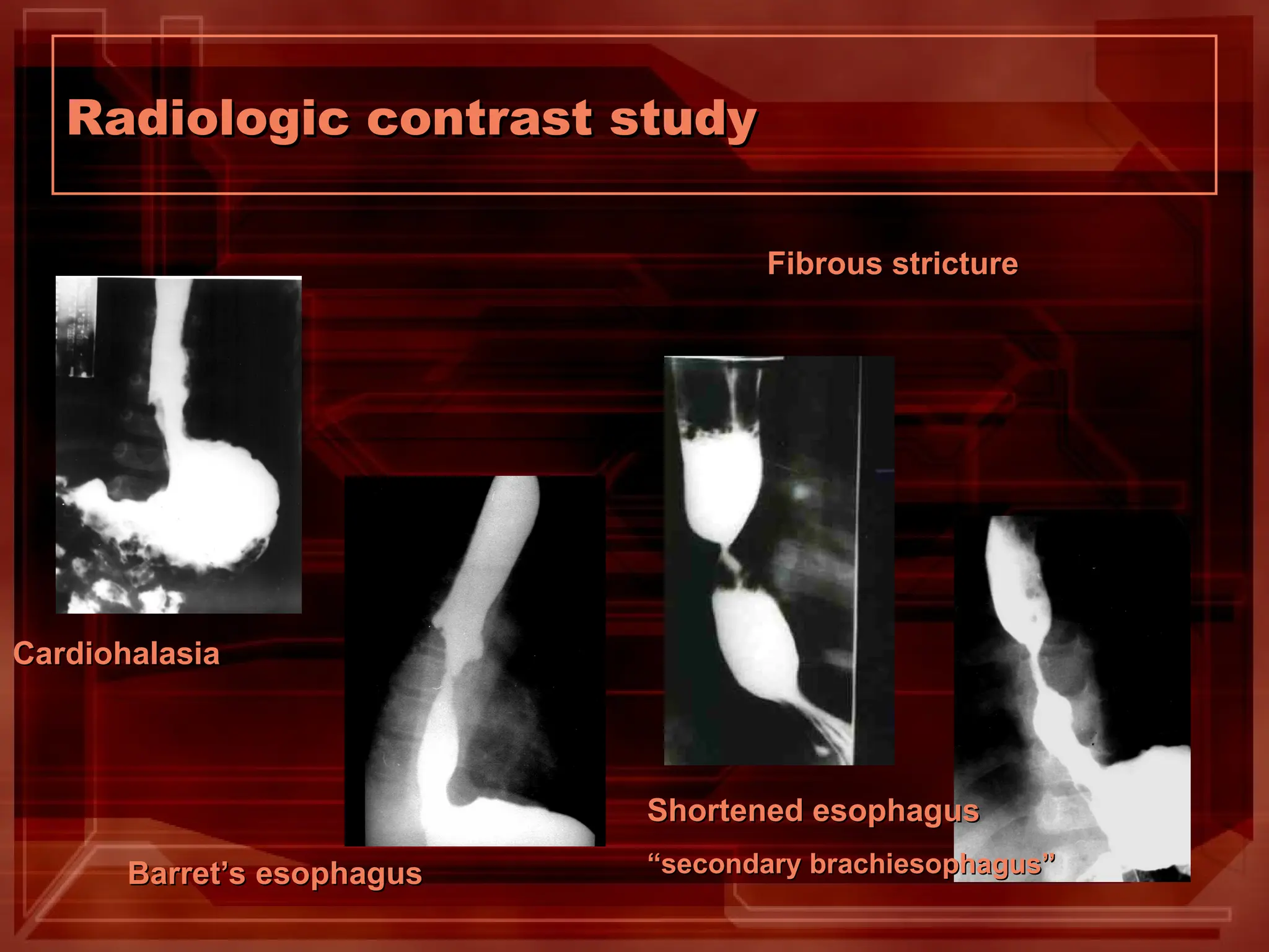 Surgical aspects in GERD in children.ppt