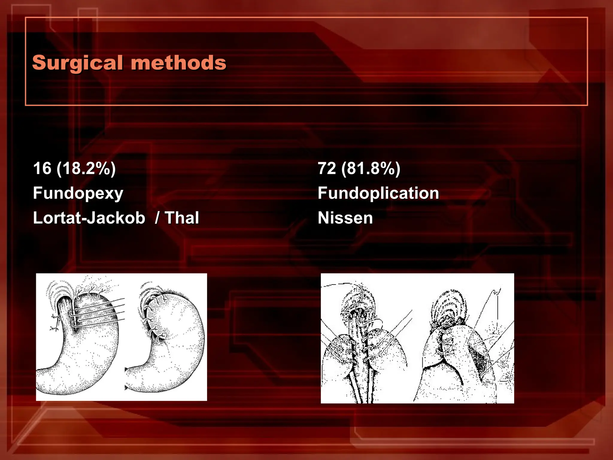 Surgical aspects in GERD in children.ppt