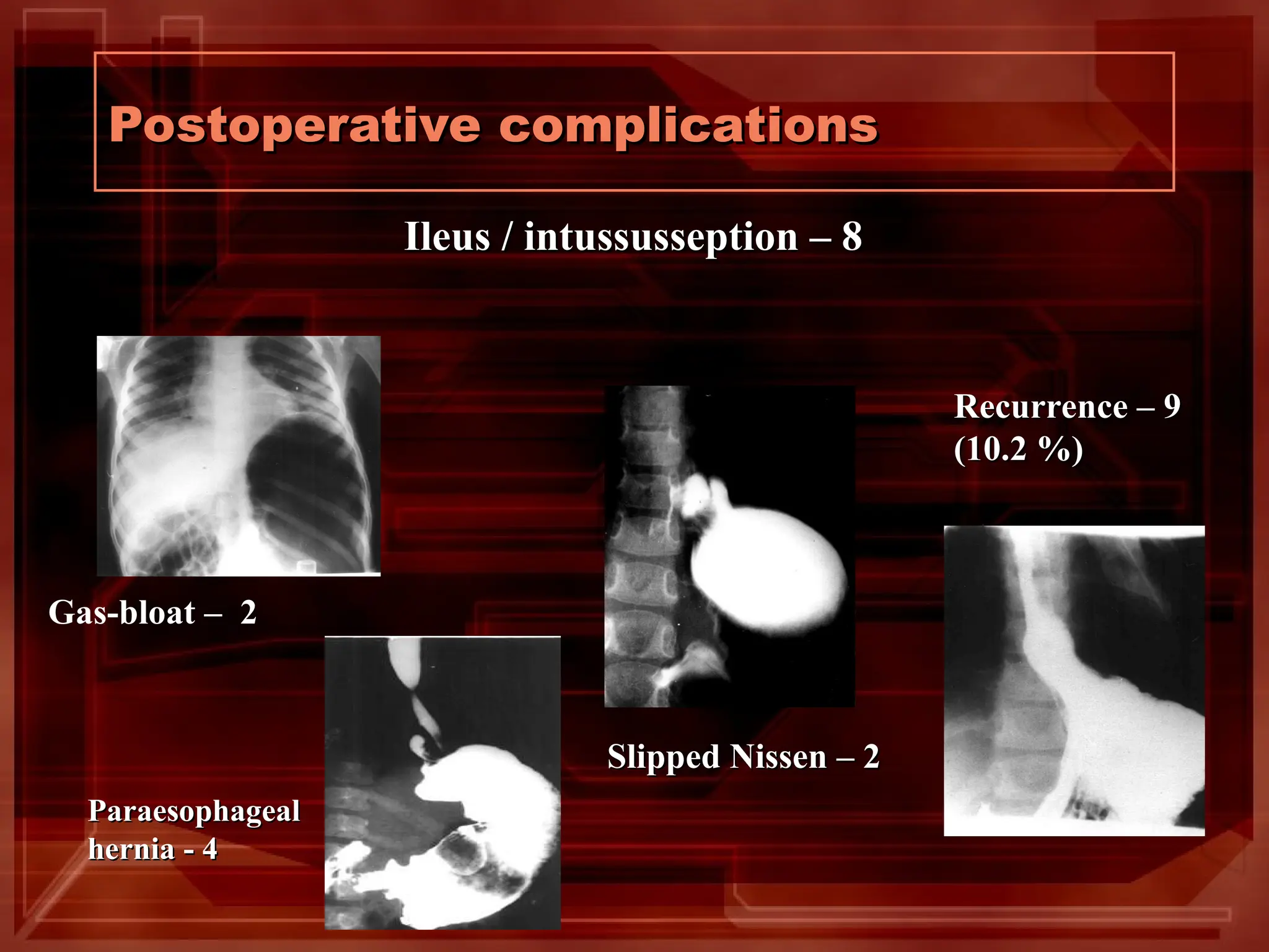 Surgical aspects in GERD in children.ppt